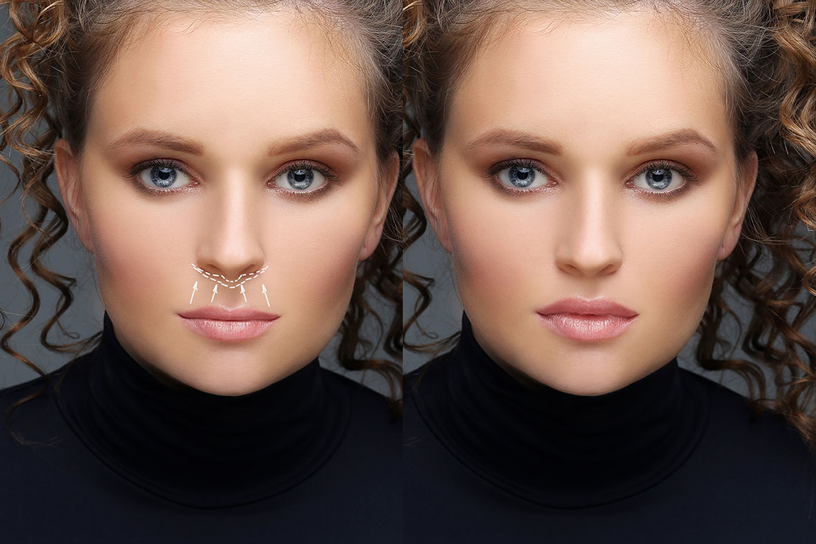 Liplift Ou Lifting De Lábios - New Face Institute